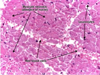 Cell injury: Necrosis and Gangrene | PPT | Free Download