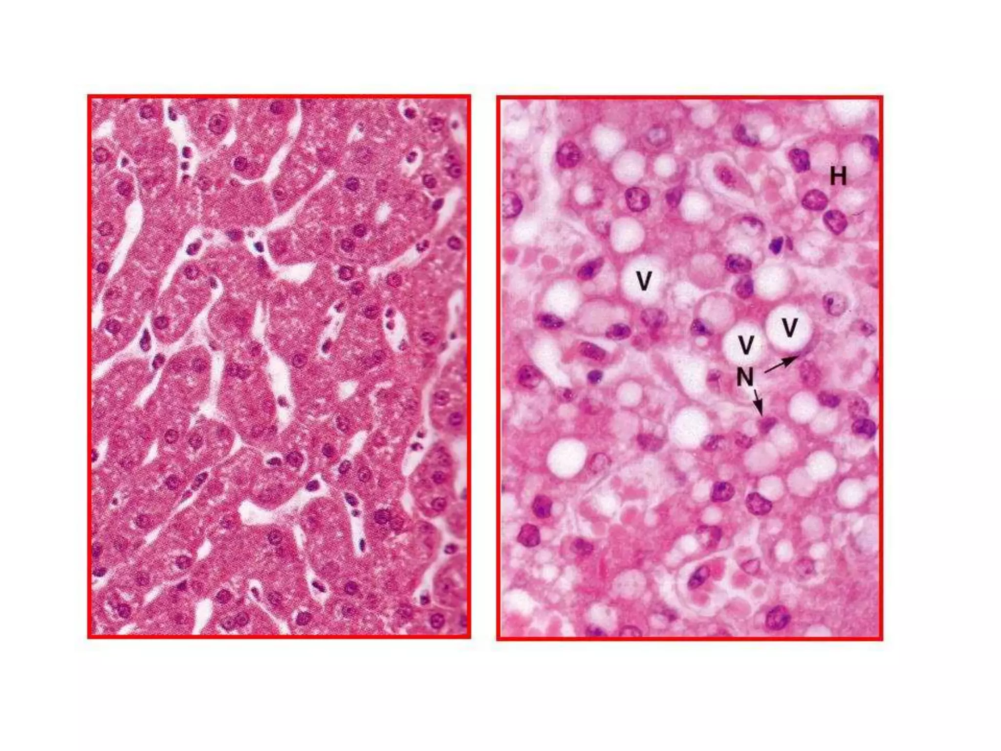 Cell injury : Intracellular accumulations | PPTX