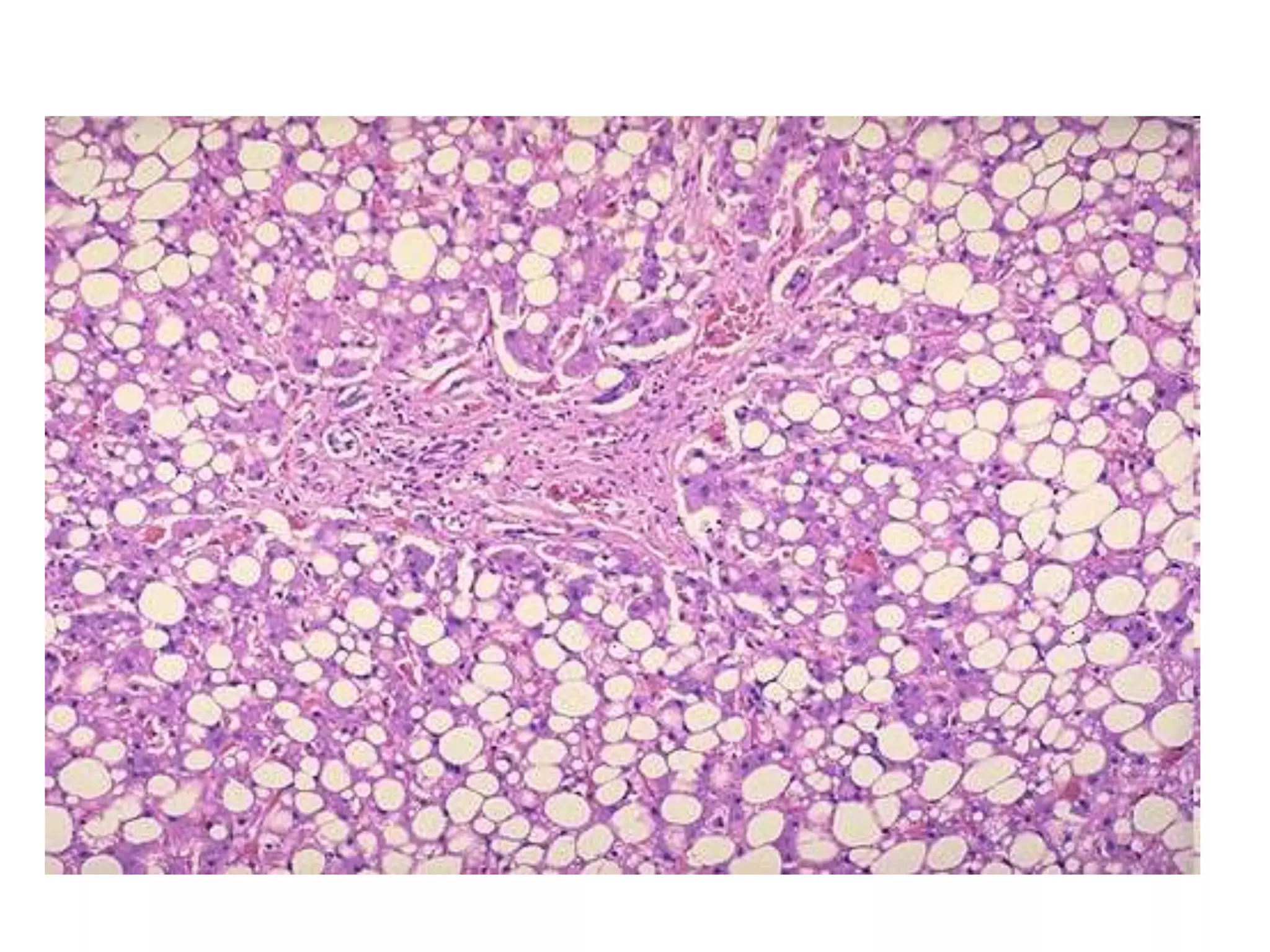 Cell injury : Intracellular accumulations | PPTX