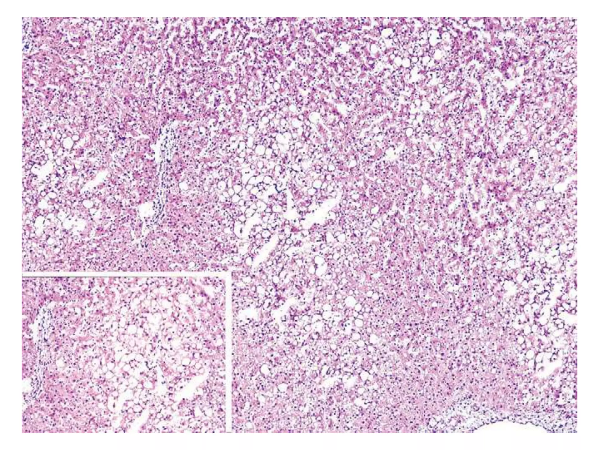 Cell injury : Intracellular accumulations | PPTX