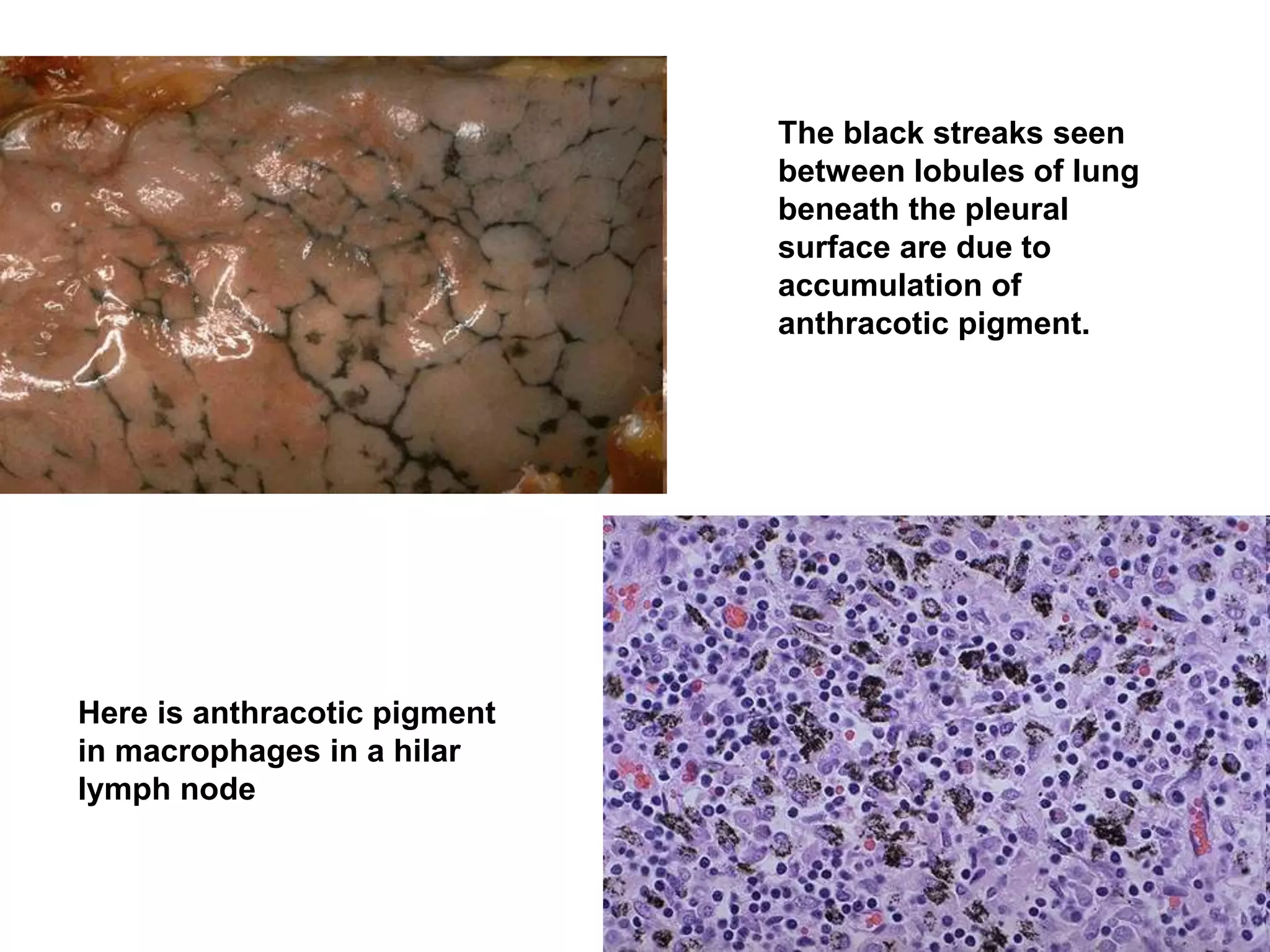 Cell injury : Intracellular accumulations | PPTX
