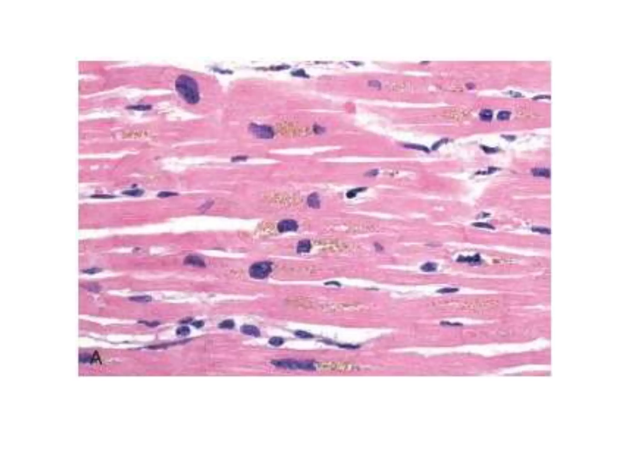 Cell injury : Intracellular accumulations | PPTX