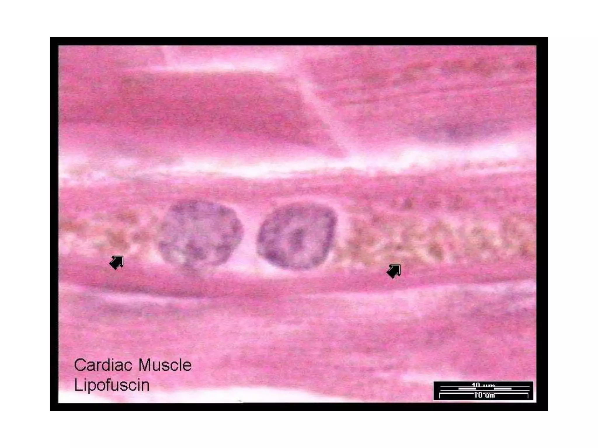 Cell injury : Intracellular accumulations | PPTX