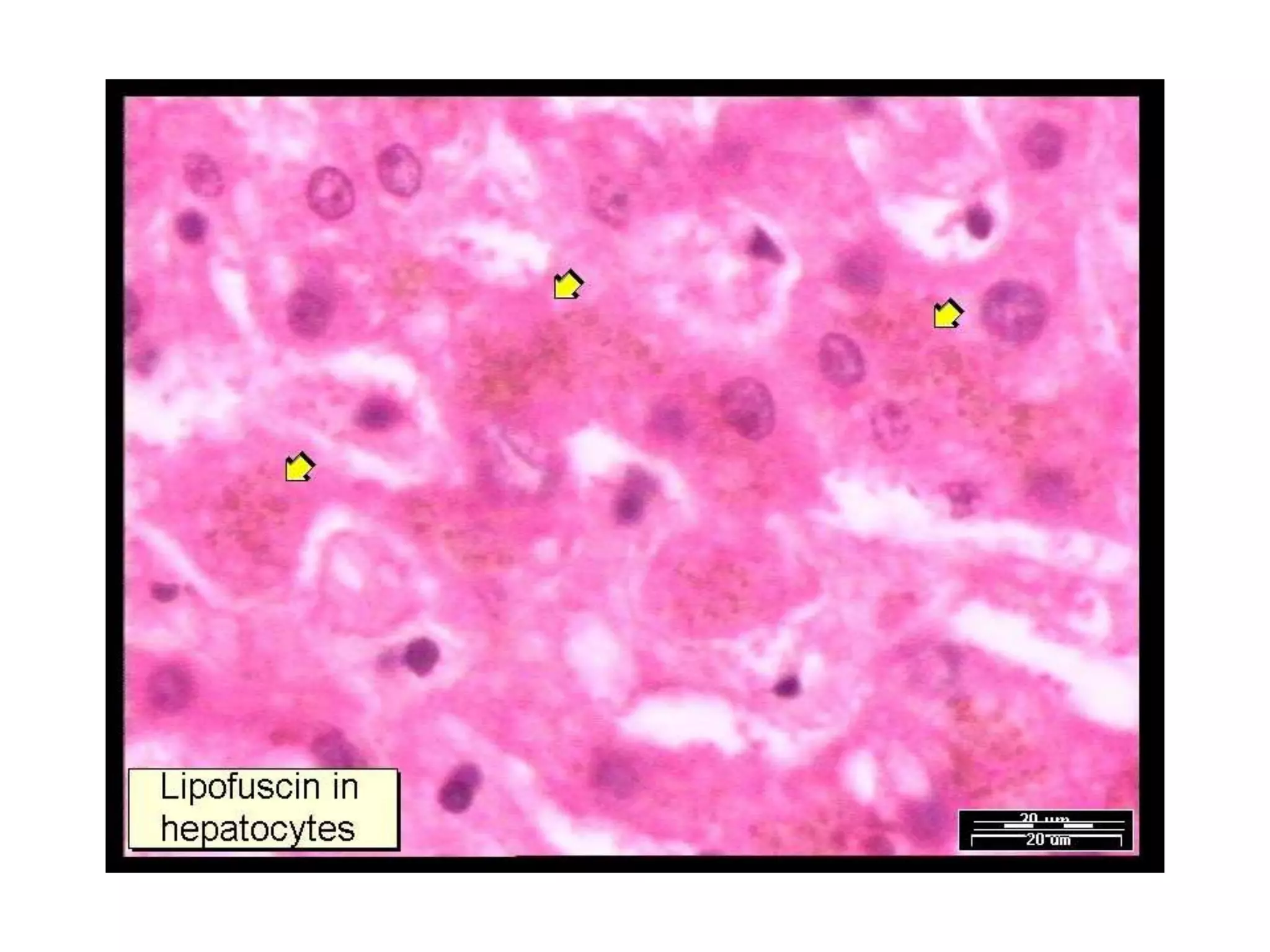 Cell injury : Intracellular accumulations | PPTX