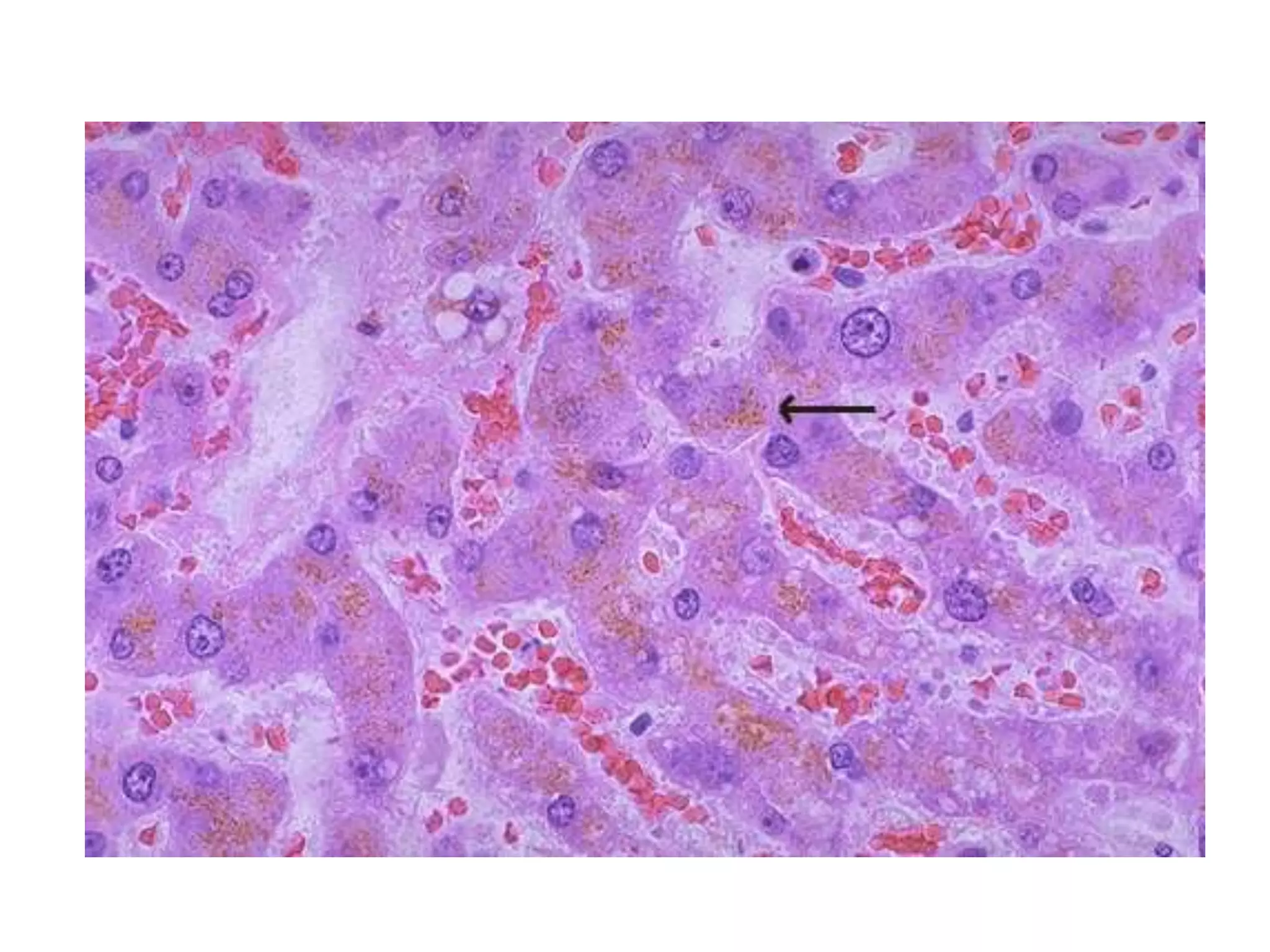 Cell injury : Intracellular accumulations | PPTX