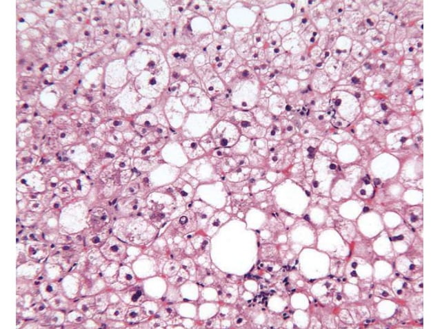 Cell injury : Intracellular accumulations | PPTX | Endocrine and ...