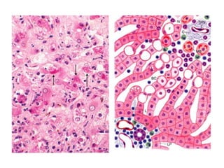 Cell injury : Intracellular accumulations | PPTX