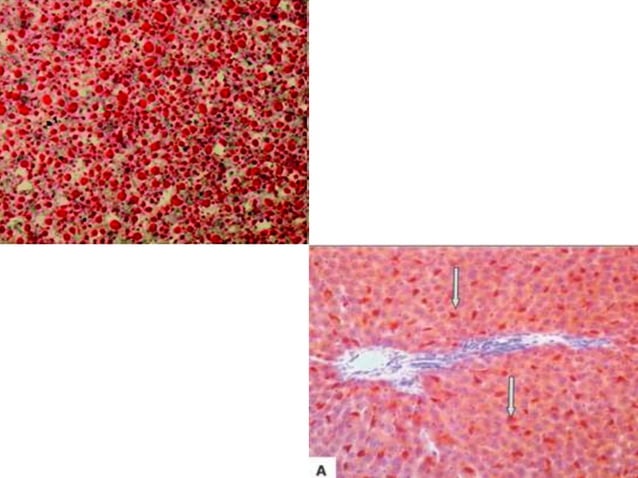 Cell injury : Intracellular accumulations | PPTX | Endocrine and ...