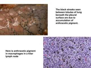 Cell injury : Intracellular accumulations | PPTX