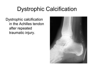 Cell injury: Pathologic calcification and Cell aging | PPTX