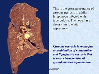 Caseous Necrosis Gross