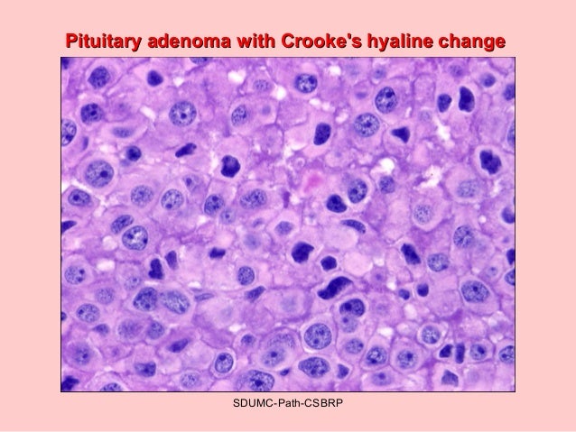 Cell injuryadaptation 6