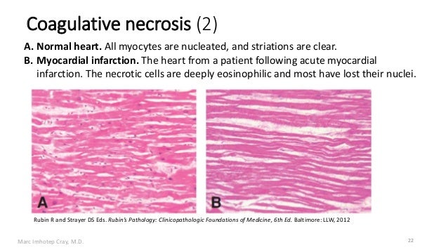 Cell Injury and Cell Death