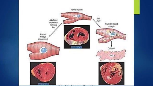 cellinjuryandhypertrophy pathology .pptx