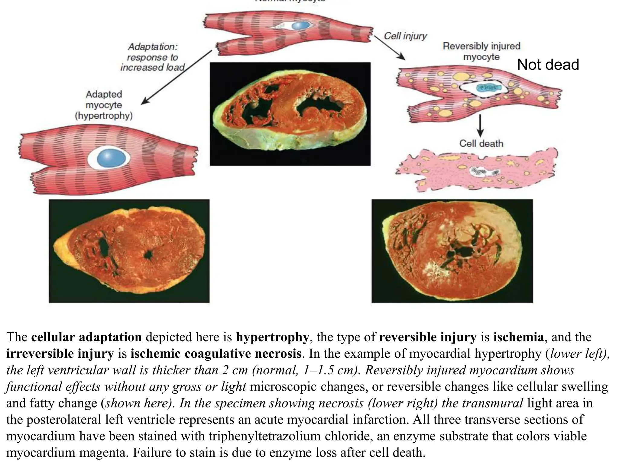 cell injury and necrosis mechanism Pathology.ppt