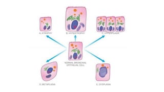 CELLULAR ADAPTATION AND ABERRANT CELL GROWTH [Autosaved].pptx