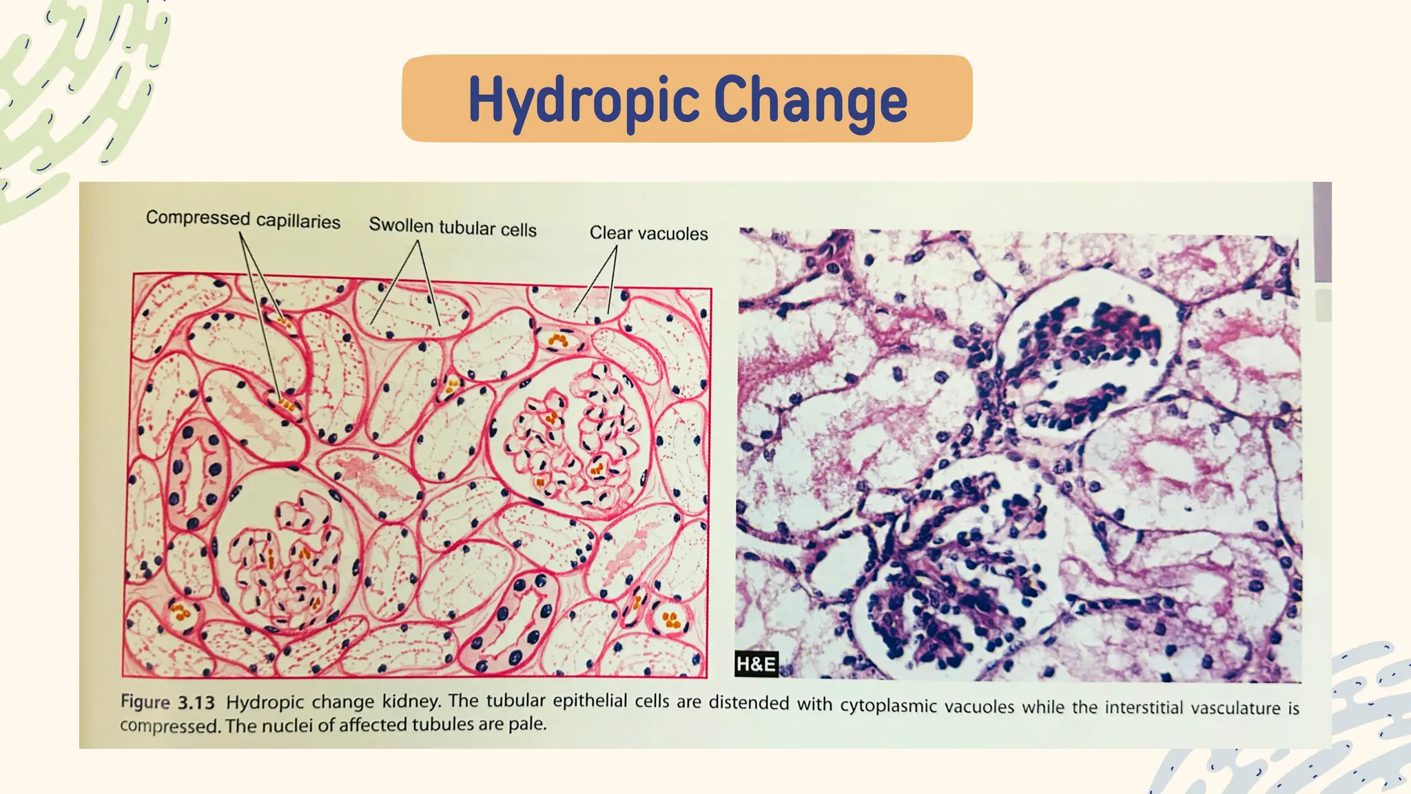 Cellular Adaptation & Cell Injury - Pathology | PDF