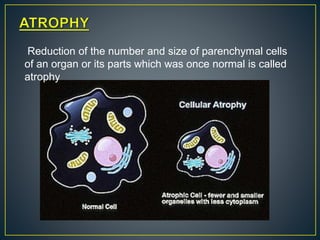 Cell Atrophy