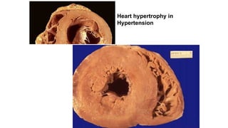 Cellular adaptations - hyperplasia, hypertrophy | PPTX