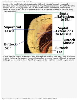 Cellulite cottage-cheese-thighs | PDF | Menopause | Endocrine and ...