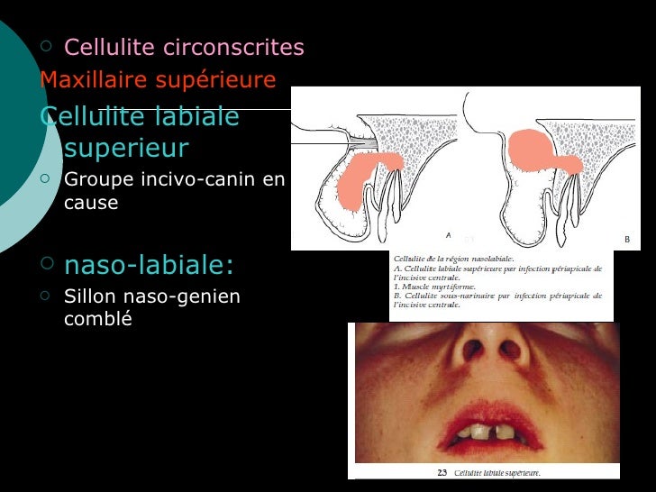 Classification des cellulites selon la topographie