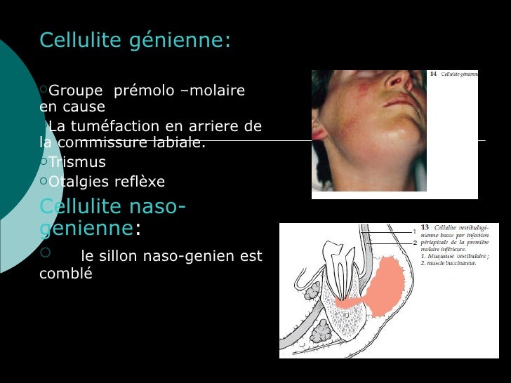 Classification des cellulites selon la topographie