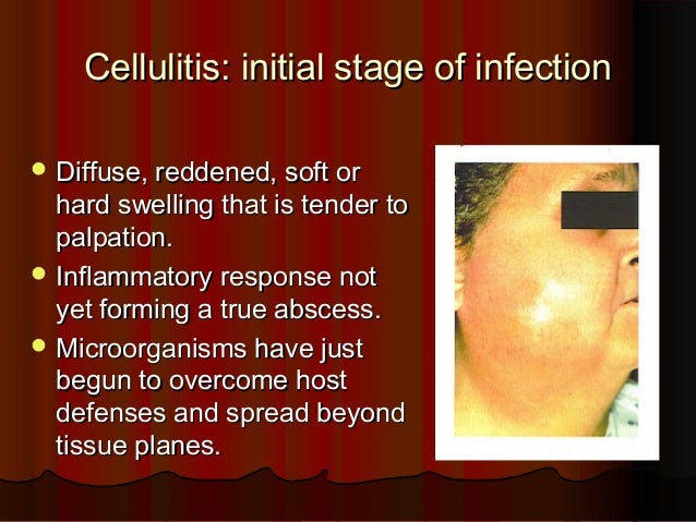 Cellulitis 110219224340-phpapp01