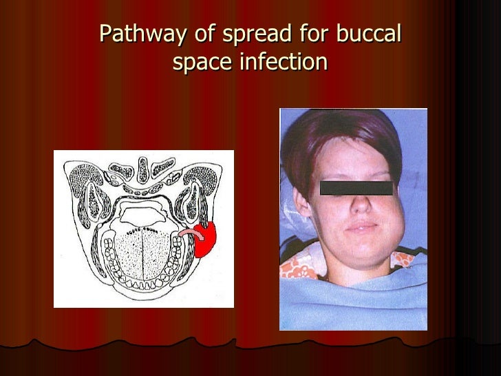 Infratemporal Space Displacement Tooth