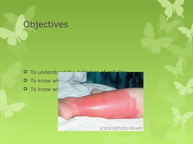 Cellulitis | PPT | Ear, Nose and Throat Conditions | Diseases and ...