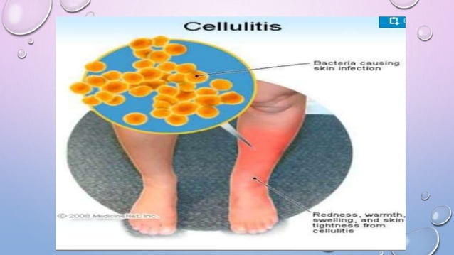 Cellulitis | PPTX | Skin and Dermatology | Diseases and Conditions