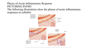 Cellulitis | PPTX