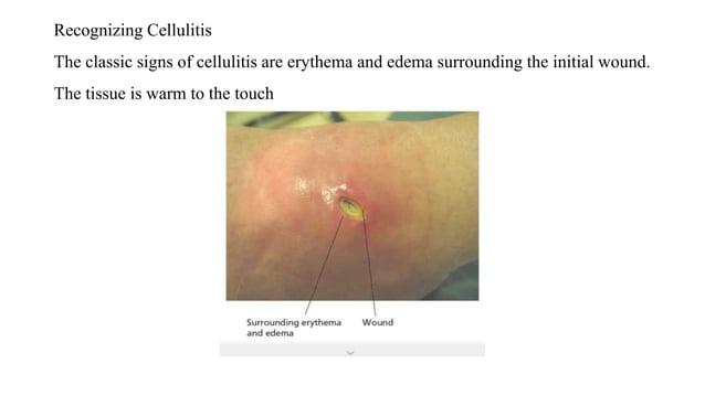 Cellulitis