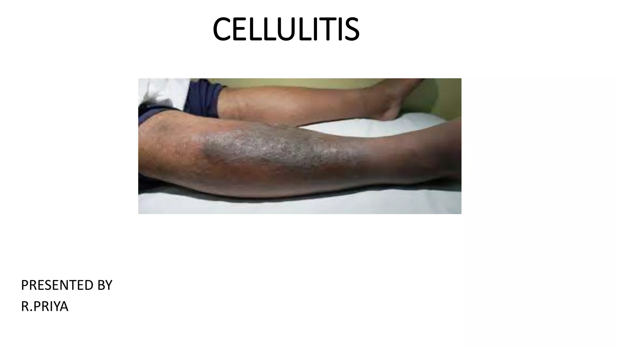 Cellulitis | PPTX