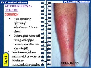 Cellulitis by Dr.K.AmrithaAnilkumar | PPT