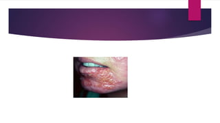 Cellulitis-2 (2).pptx