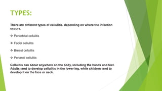Cellulitis | PPTX