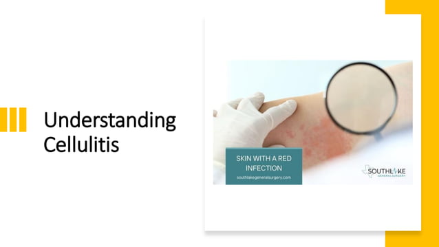 Cellulitis - Causes, Treatments, and Recovery.pdf | Infectious Diseases | Diseases and Conditions