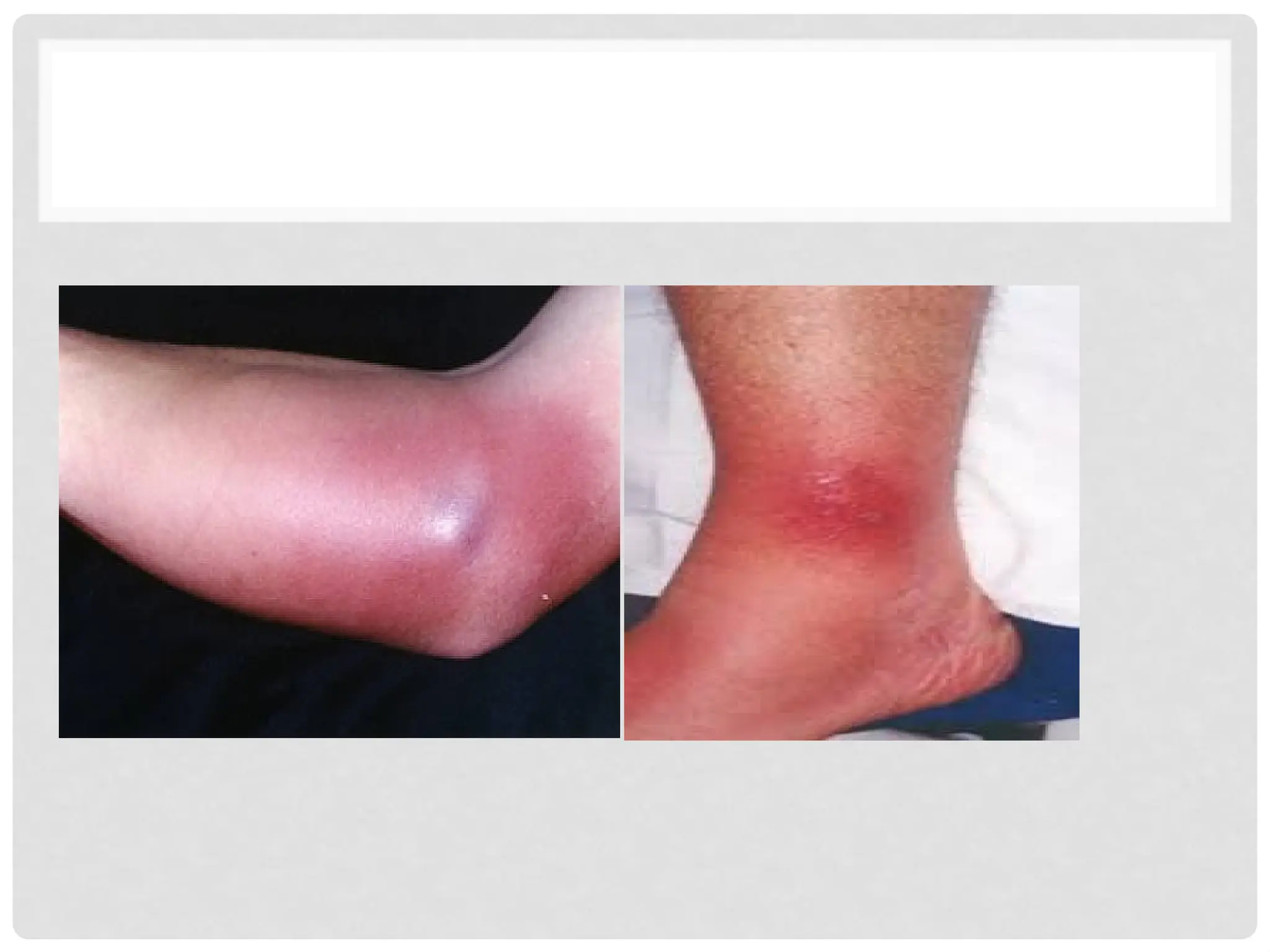 Understanding Cellulitis: Causes, Symptoms, and Treatment Approaches | PPTX