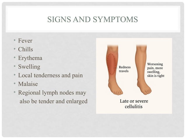 Understanding Cellulitis: Causes, Symptoms, and Treatment Approaches | PPTX