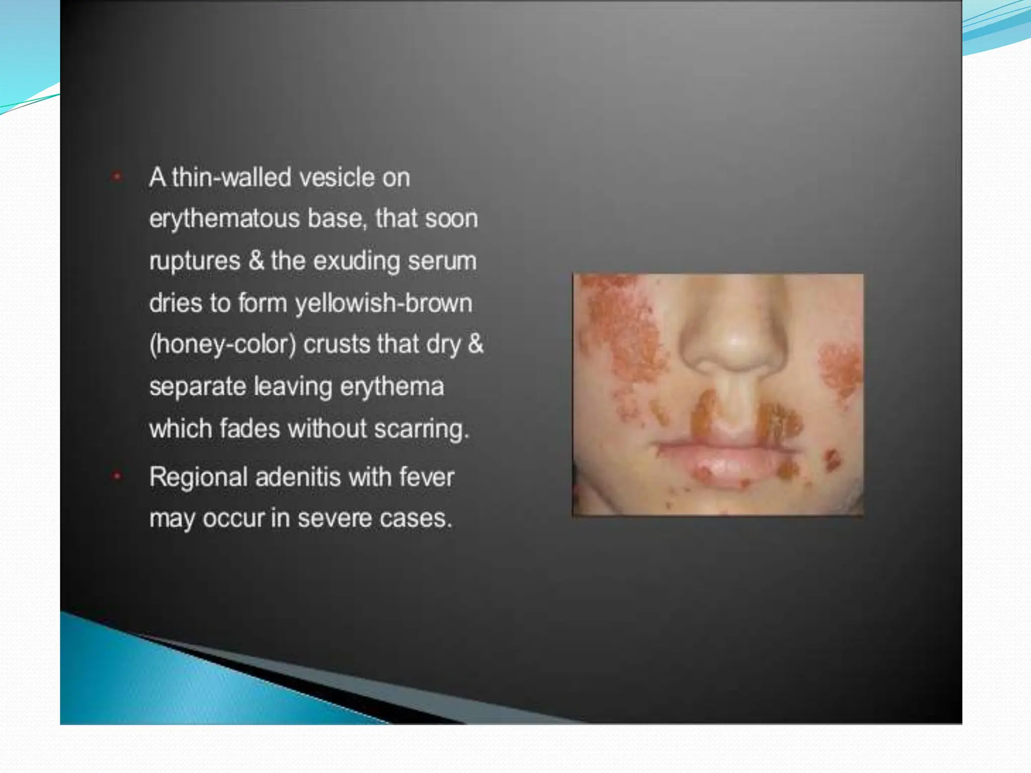 CELLULITIS superficial bacterial infection.pptx