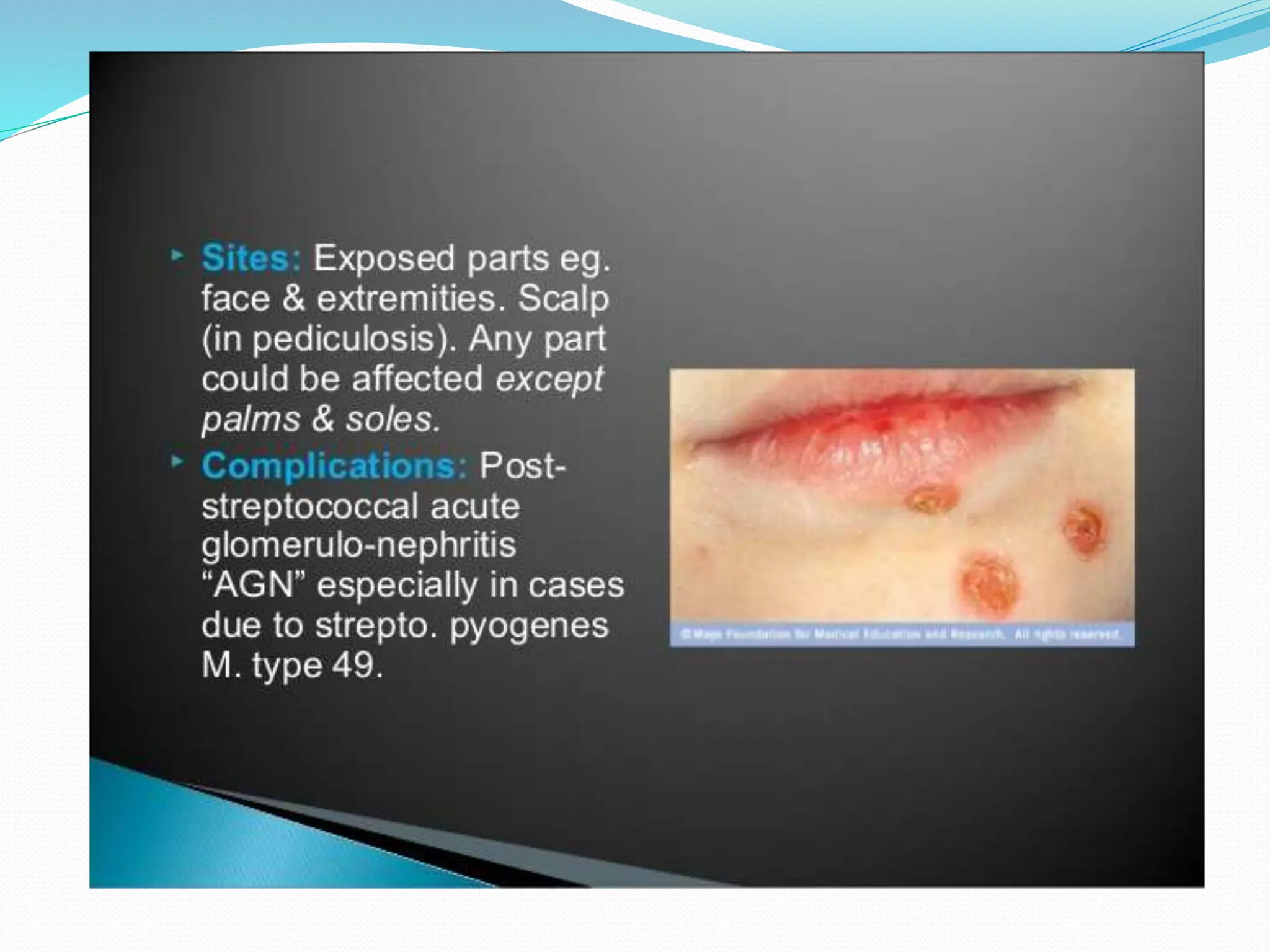 CELLULITIS superficial bacterial infection.pptx