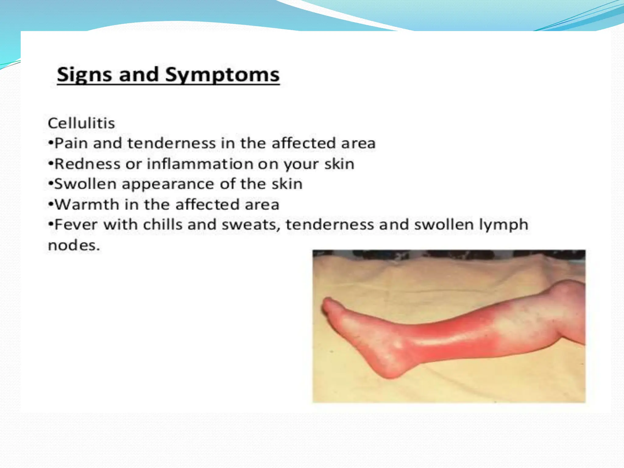 CELLULITIS superficial bacterial infection.pptx