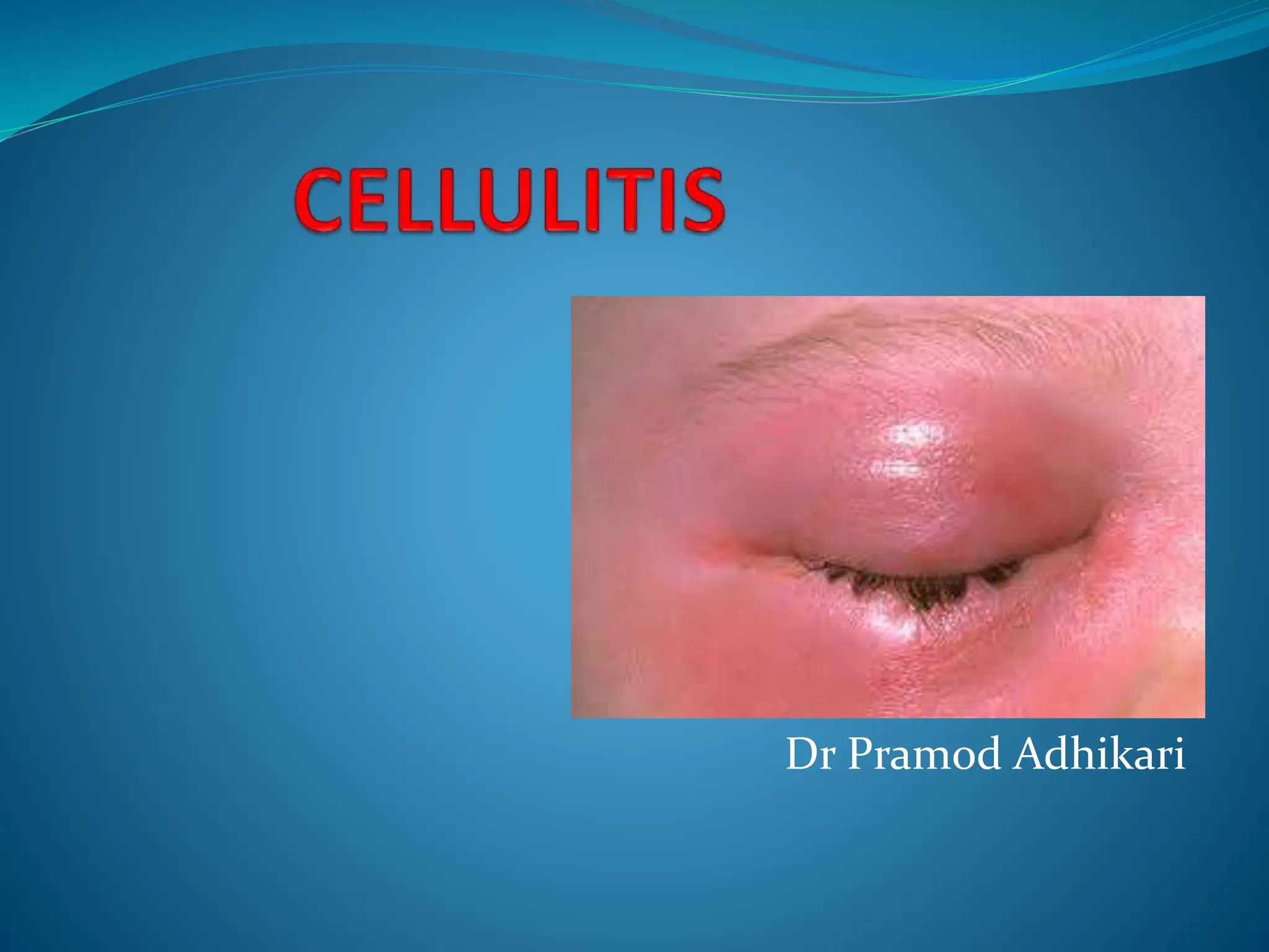 CELLULITIS superficial bacterial infection.pptx