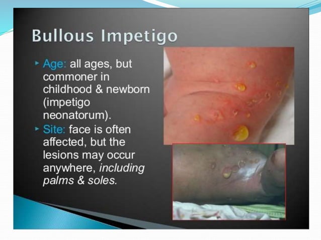 CELLULITIS superficial bacterial infection.pptx