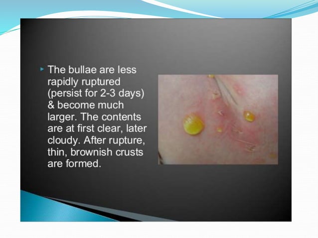 CELLULITIS superficial bacterial infection.pptx