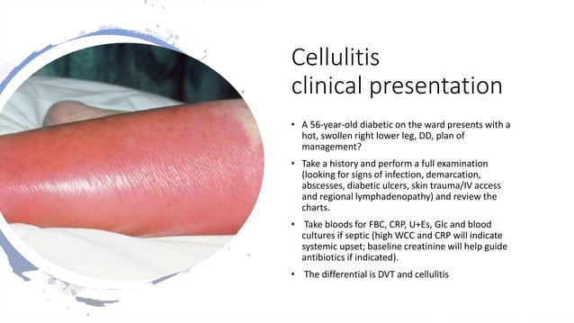 cellulitis and burn.pptx