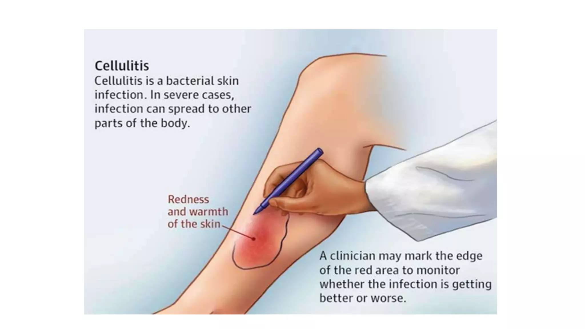 CELLULITIS AND NECROTISING FASCITIS PPT.pptx