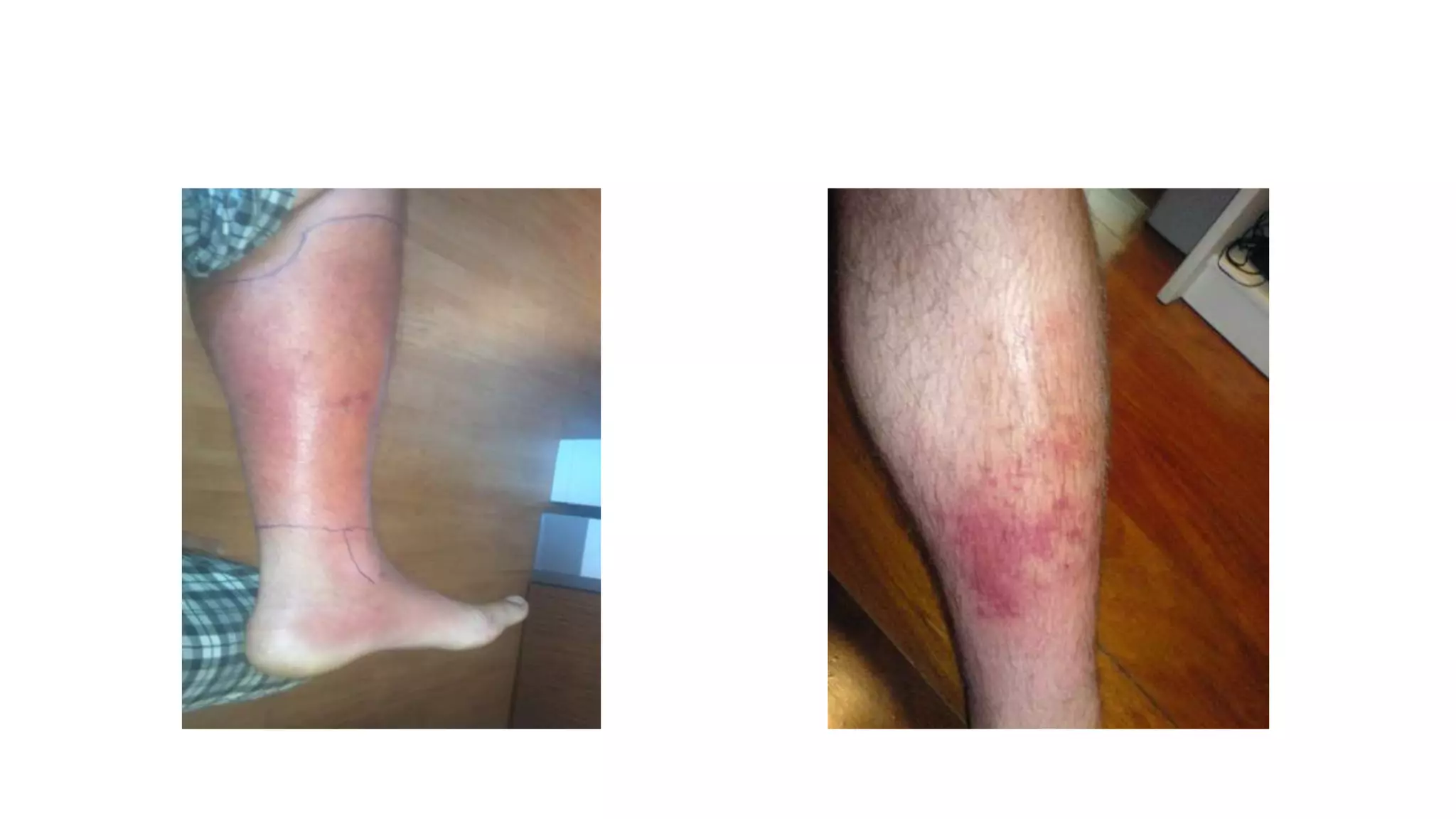 CELLULITIS AND NECROTISING FASCITIS PPT.pptx