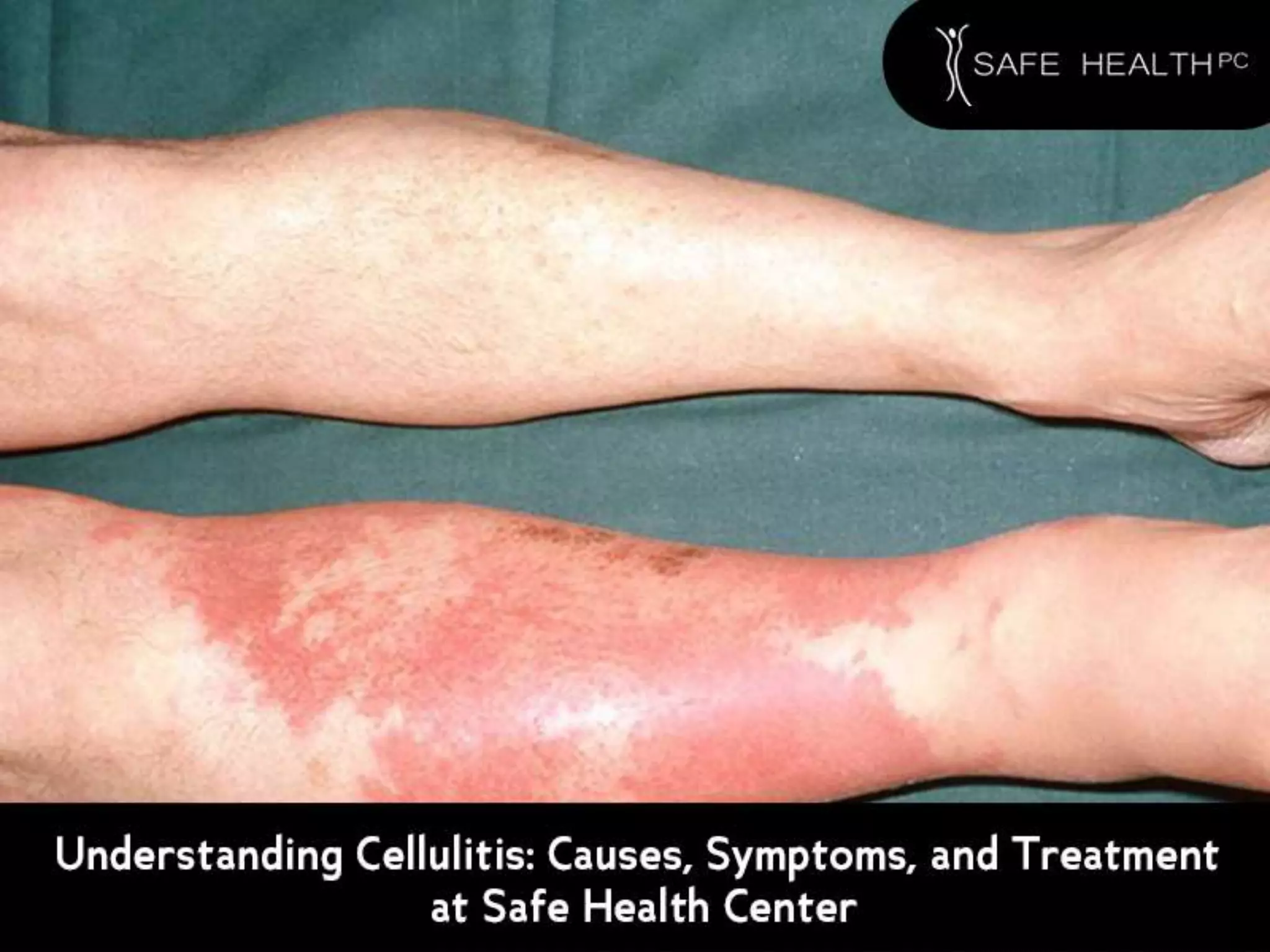 cellulitis causes,symptoms and treatment at safe health center in Mt Pleasant, MI.pptx