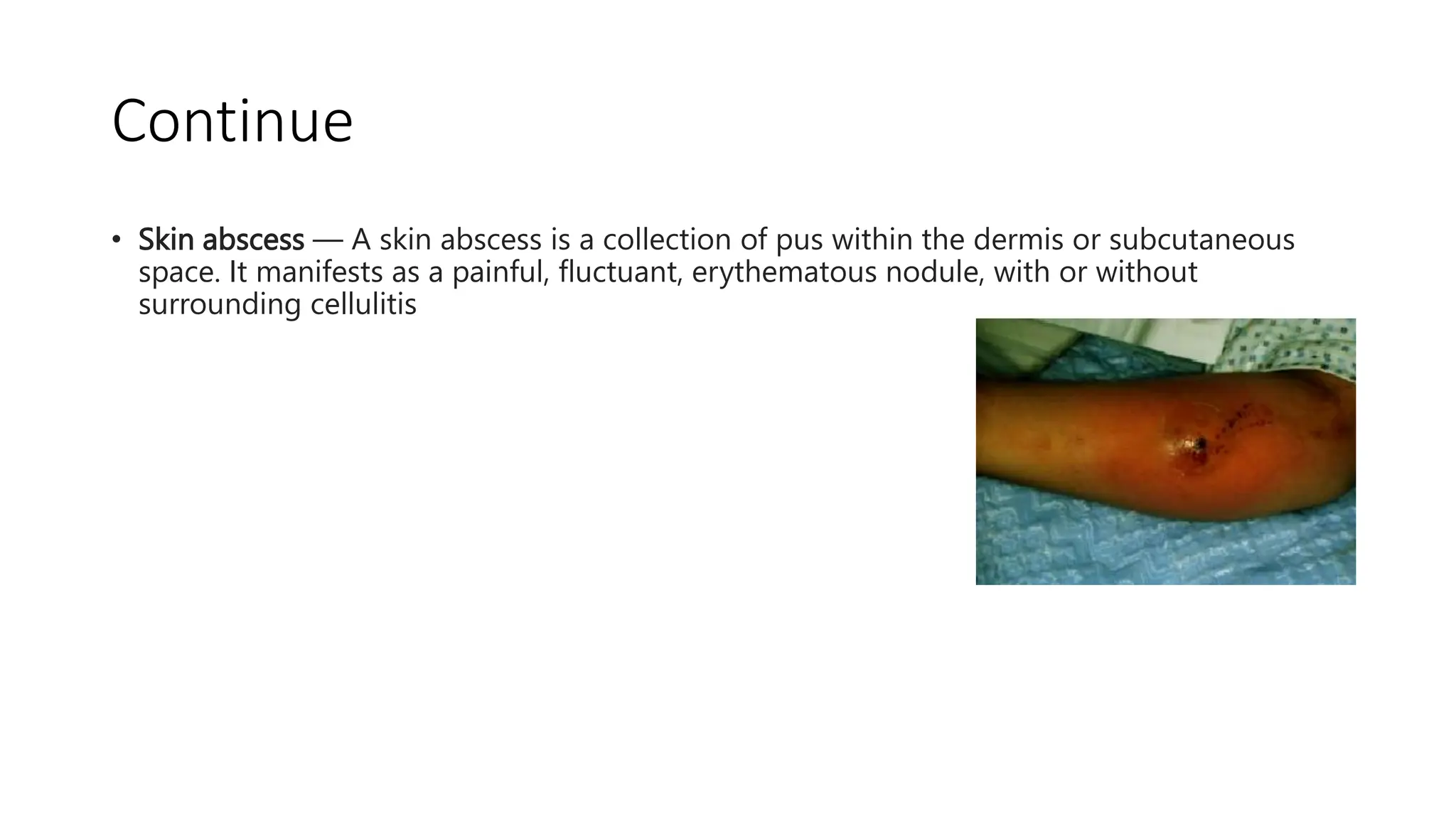 Cellulitis, erysipelas, abscess presentation | PPTX